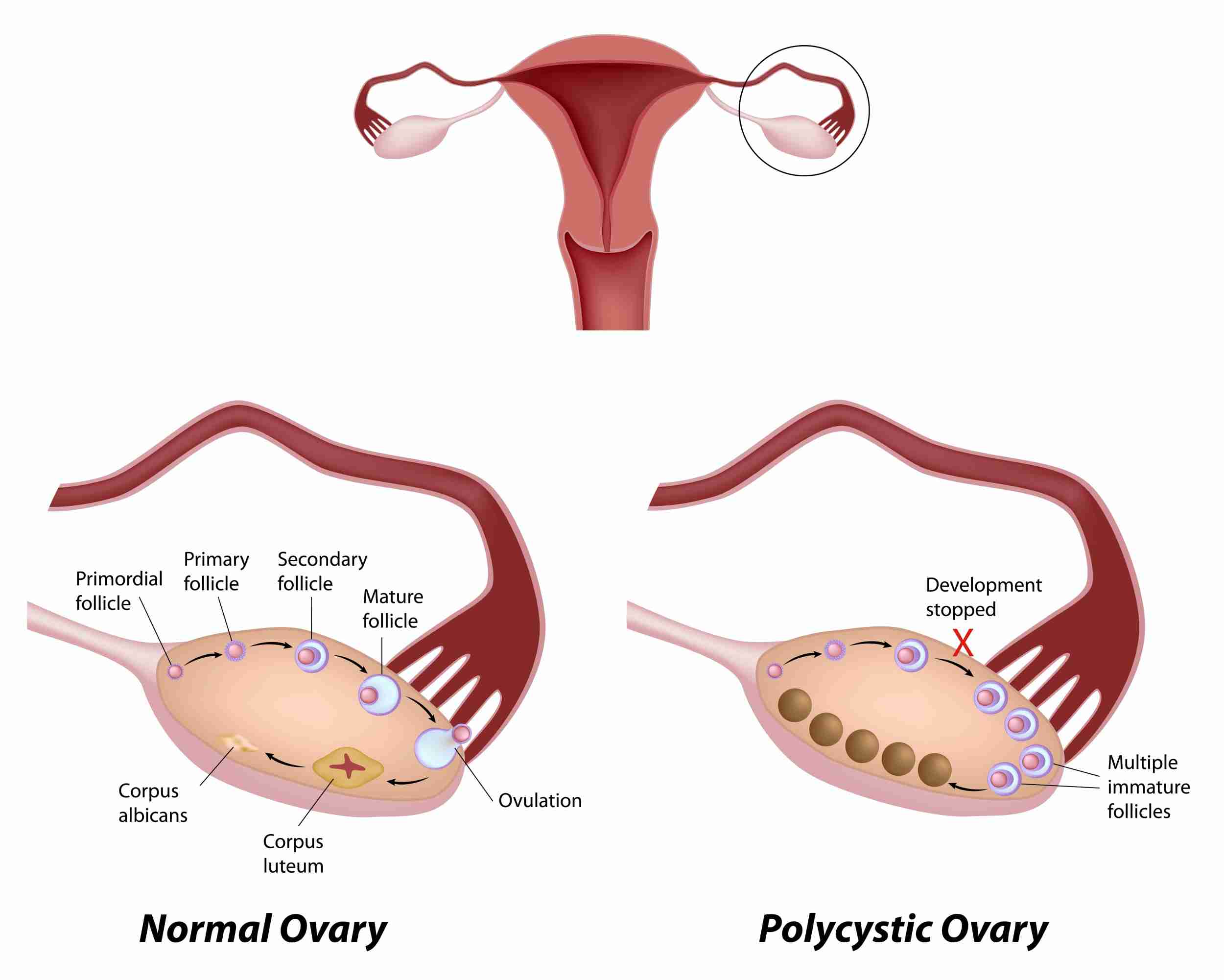 PCOS and Hyperinsulinemia - PCOS 8 - The Fasting Method